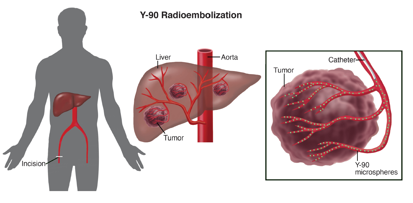 ‘The future of cancer therapy’: An innovative treatment performed at St ...
