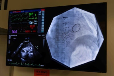 St. Michael’s is a leader in EVOQUE transcatheter tricuspid valve ...